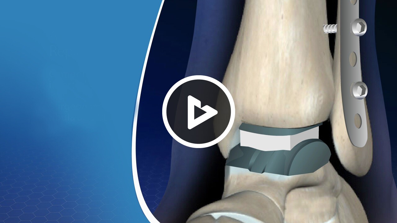 Ankle Replacement - Foot & Ankle - Willis Knighton Orthopaedic and ...