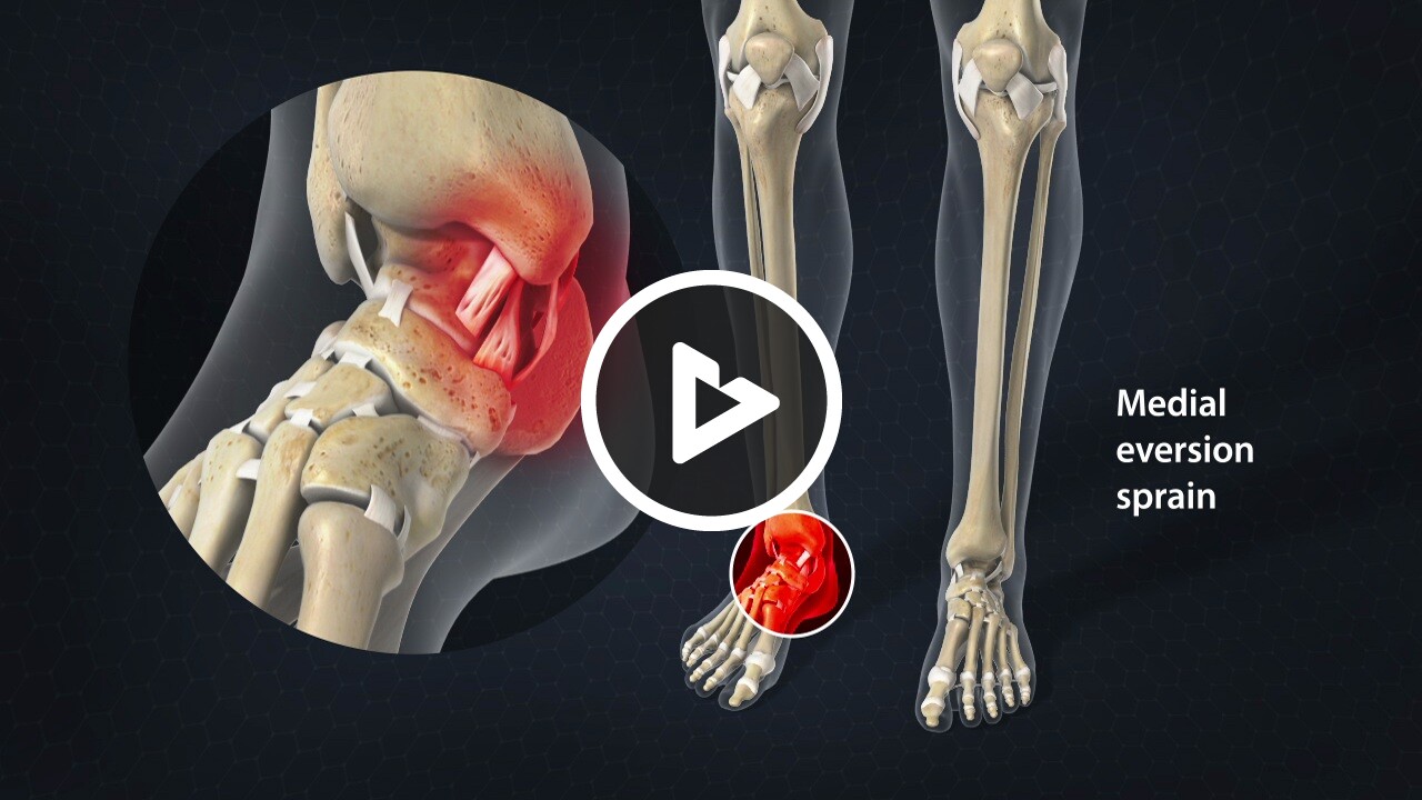 Ankle Sprains - Foot & Ankle - The Orthopaedic Clinic - Orthopedic ...
