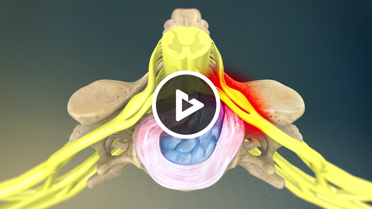 Herniated Disc (Cervical) - Neck, Spine & Back - Willis Knighton ...