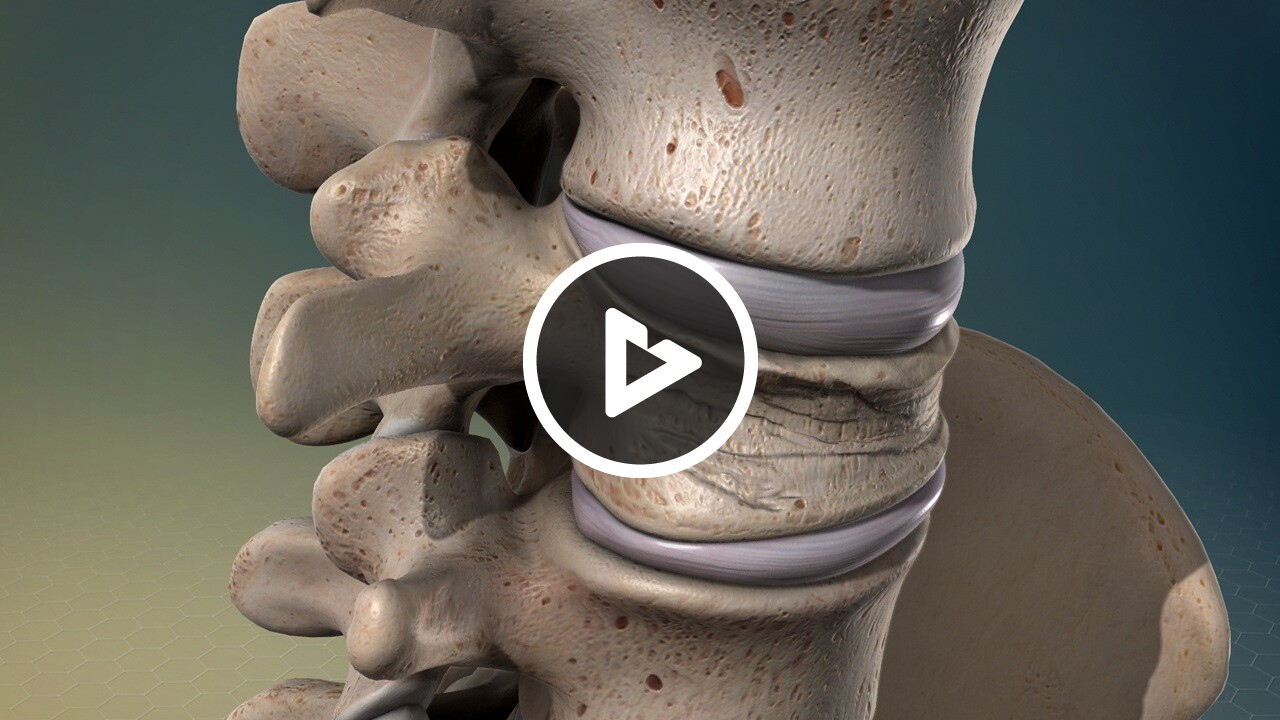 Compression Fractures of the Spine - Neck, Spine & Back - The ...