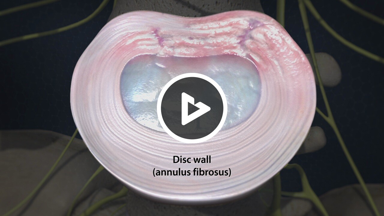 Degenerative Disc Disease - Neck, Spine & Back - Willis Knighton ...