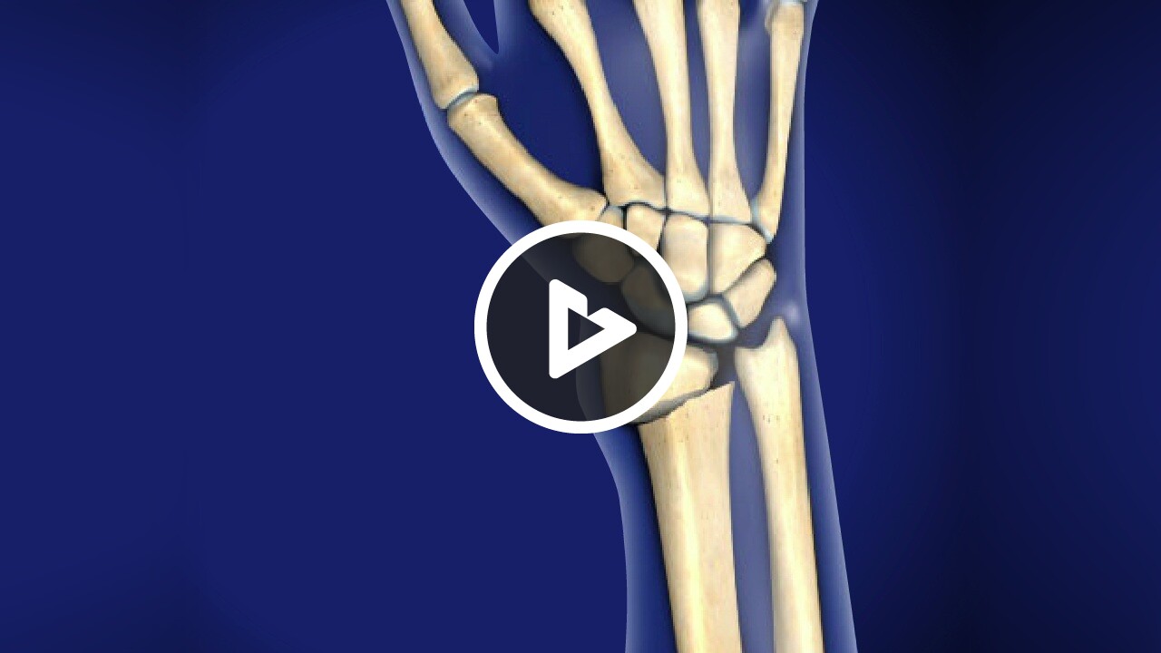 Distal Radius Fracture (Broken Wrist) - Hand, Wrist & Elbow - The Orthopaedic Clinic ...