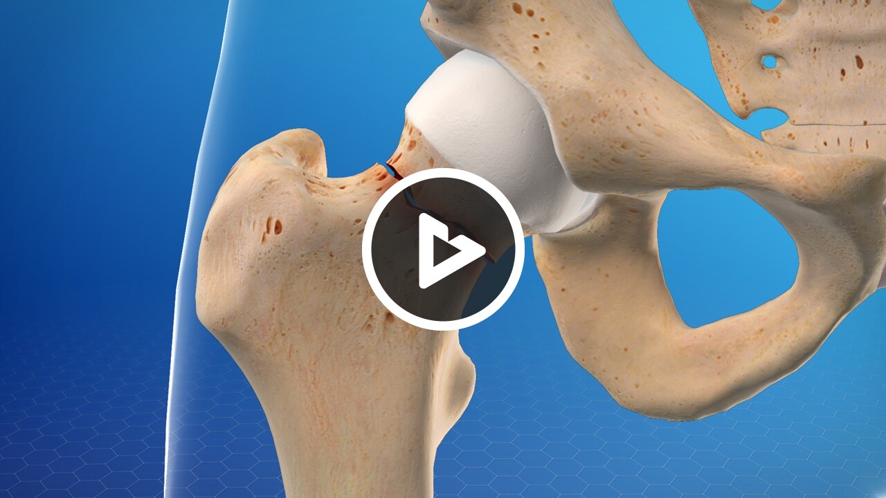 Hip Fracture - Hip & Upper Thigh - The Orthopaedic Clinic - Orthopedic ...