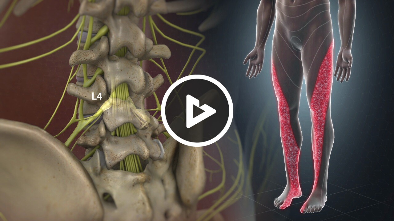 Lumbar Radiculopathy (Sciatica) - Neck, Spine & Back - The Orthopaedic Clinic - Orthopedic ...