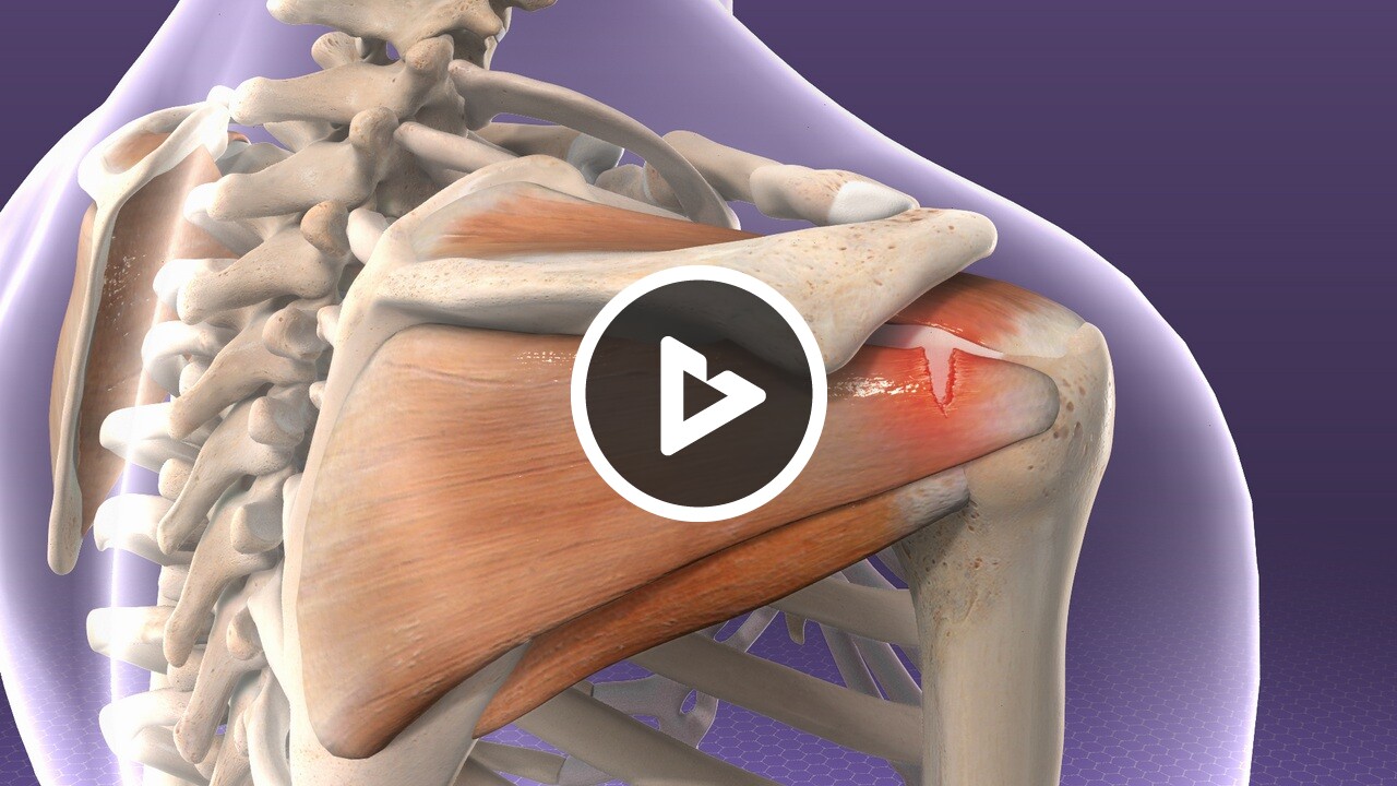 Rotator Cuff Tear - Shoulder - The Orthopaedic Clinic - Orthopedic ...