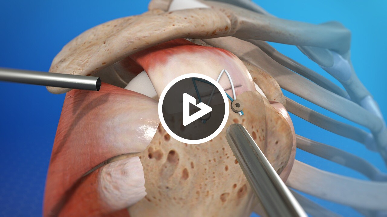 Rotator Cuff Repair (Arthroscopic) - Shoulder - The Orthopaedic Clinic ...