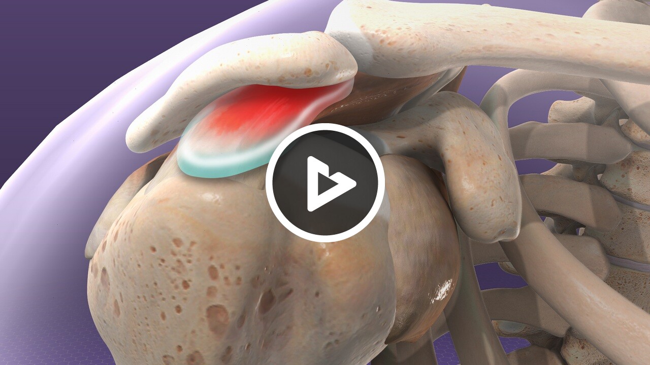 Shoulder Impingement Syndrome - Shoulder - The Orthopaedic Clinic ...