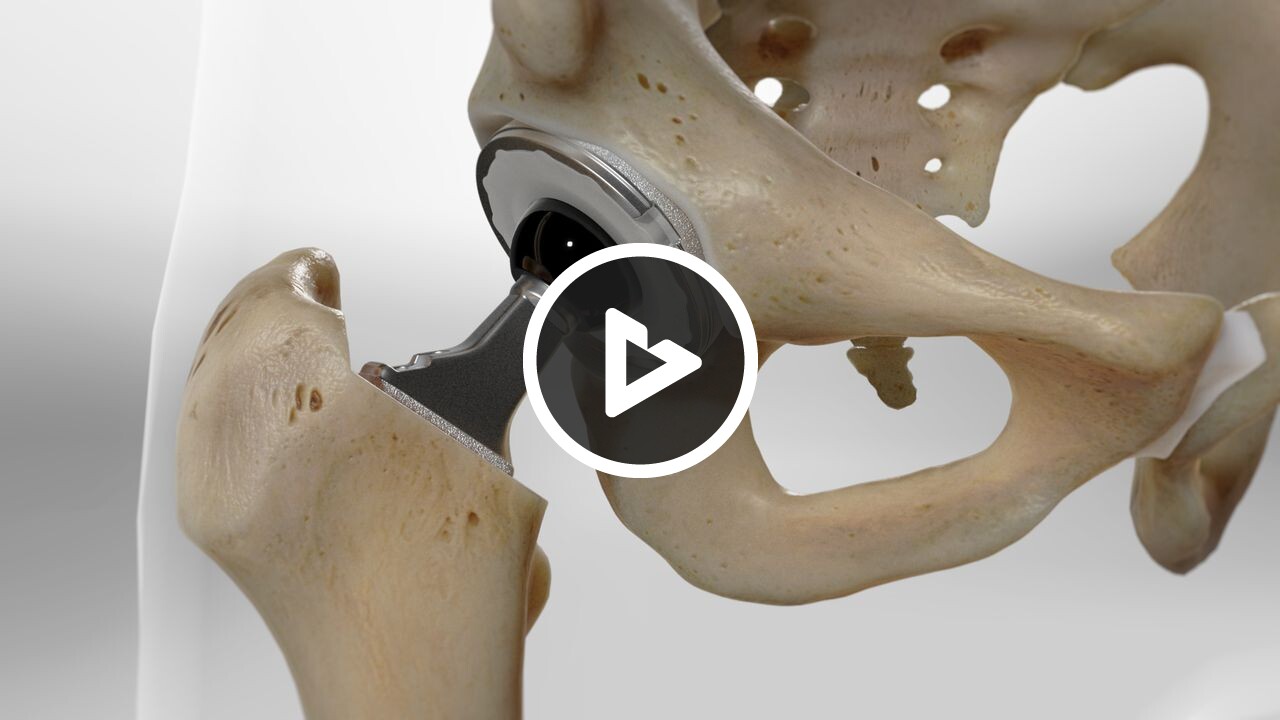 Total Hip Replacement - Hip & Upper Thigh - The Orthopaedic Clinic ...