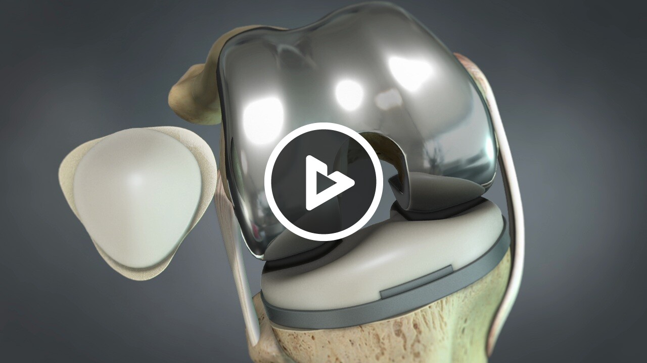 Total Knee Replacement - Knee & Lower Leg - Willis Knighton Orthopaedic ...
